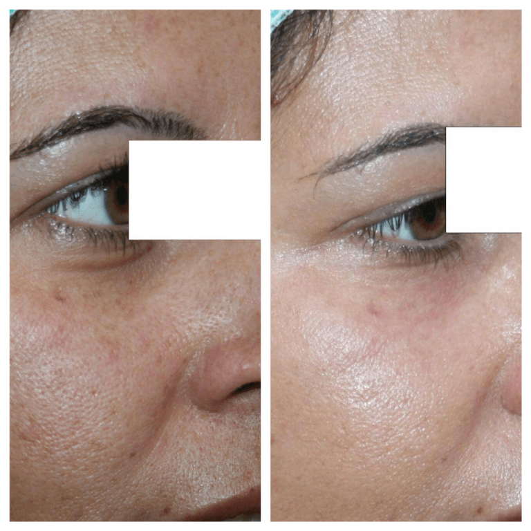 ¿Más belleza en la mirada? Eliminación de ojeras - Clínica Kalos